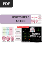 ECG Criteria for STEMI and J-Point | PDF | Electrocardiography ...