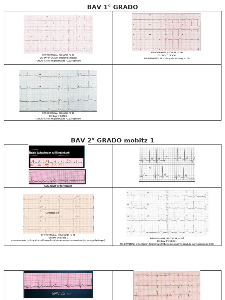 Diagnóstico de BAV 1 y 2 Mobitz | PDF | Enfermedades cardiovasculares ...