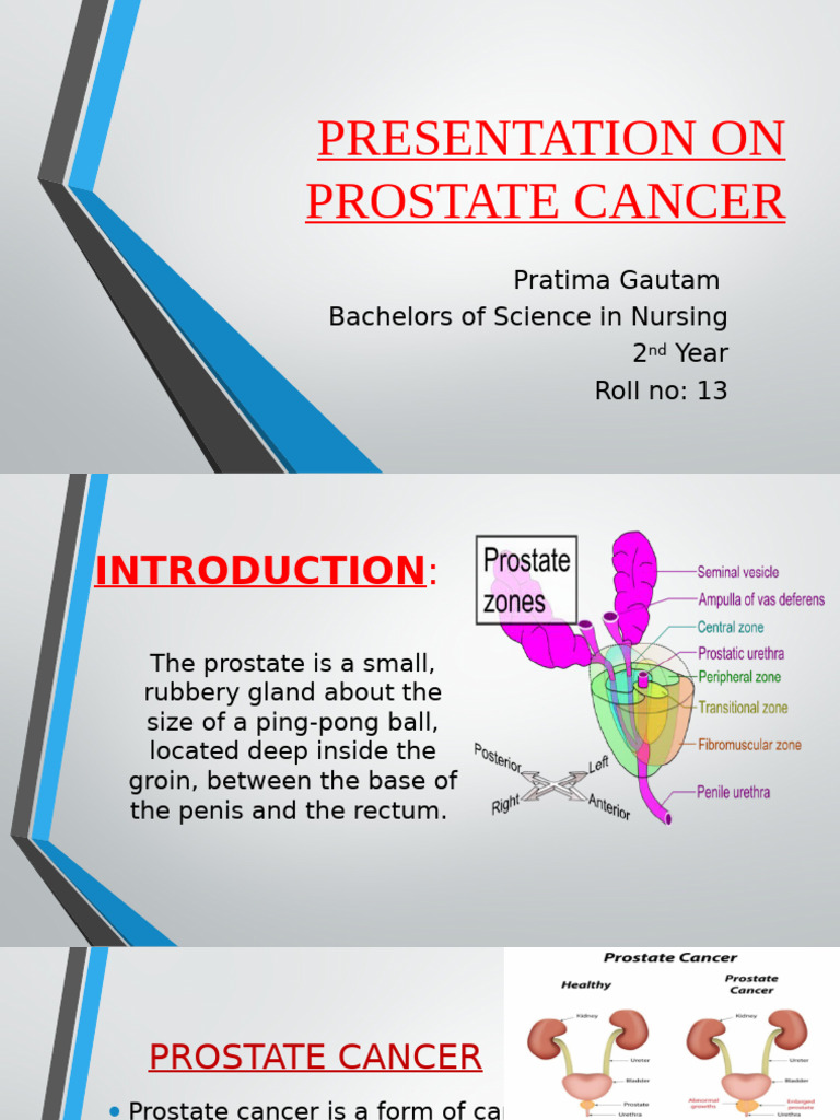 Prostate Cancer Overview and Management | PDF