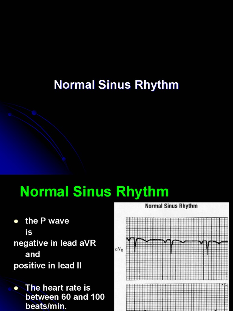 Normal Sinus Rhythm | PDF | Cardiac Arrhythmia | Heart