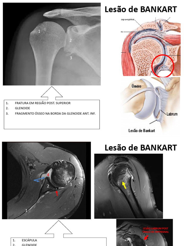 Apoio - Bankart | PDF