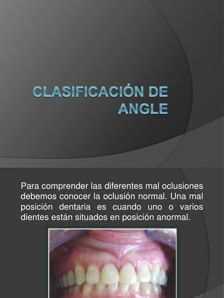 Clasificación de Angle en Maloclusiones | PDF | Ortodoncia | Diente