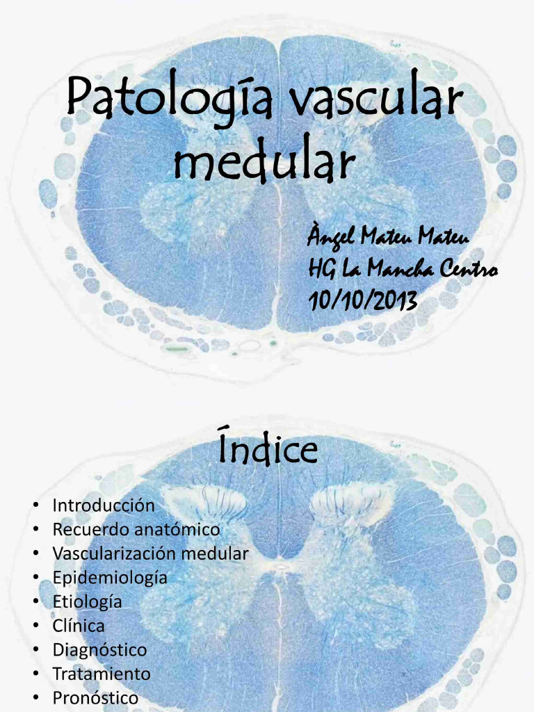 Infarto Medular | PDF