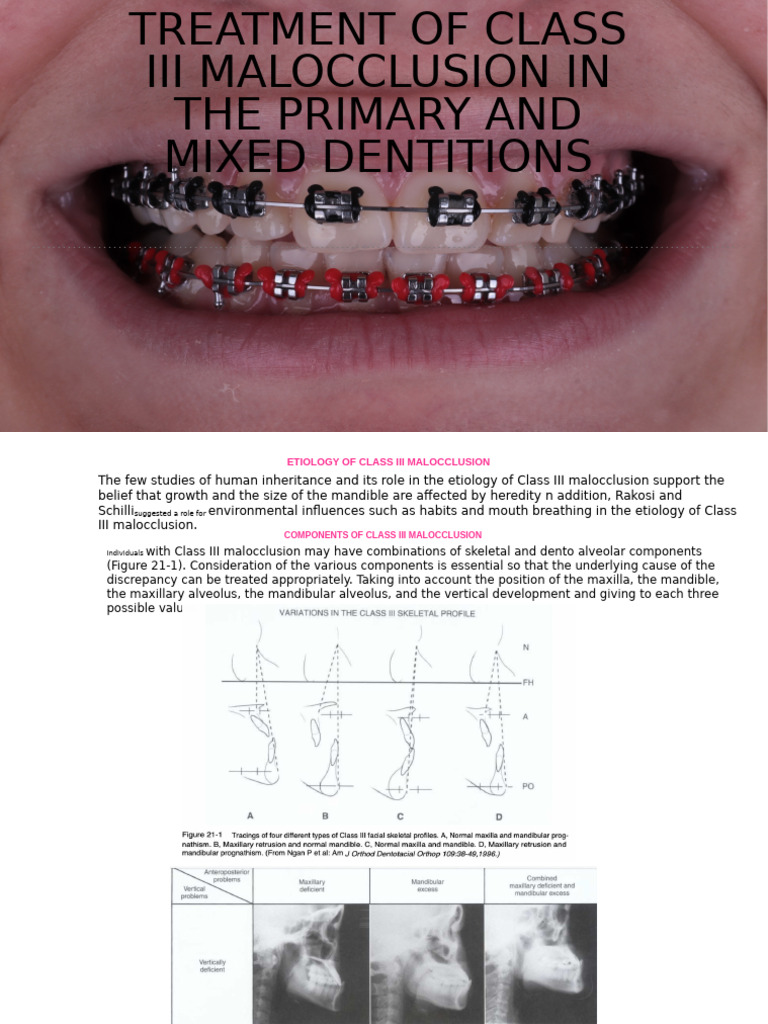 Class III Malocclusion Treatment Guide | PDF | Dental Anatomy | Mouth