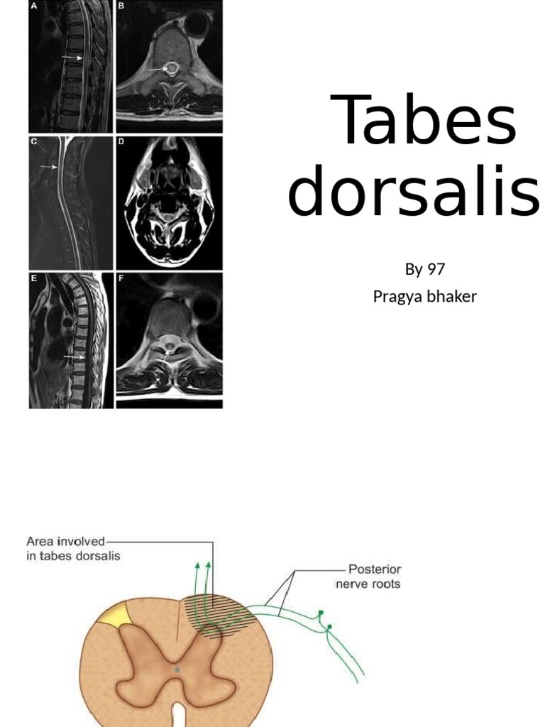 Tabes Dorsalis-WPS Office | PDF