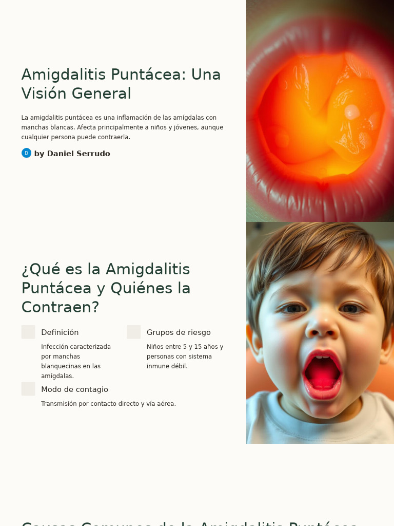 Amigdalitis Puntacea Una Vision General | PDF | Estreptococo | Infección