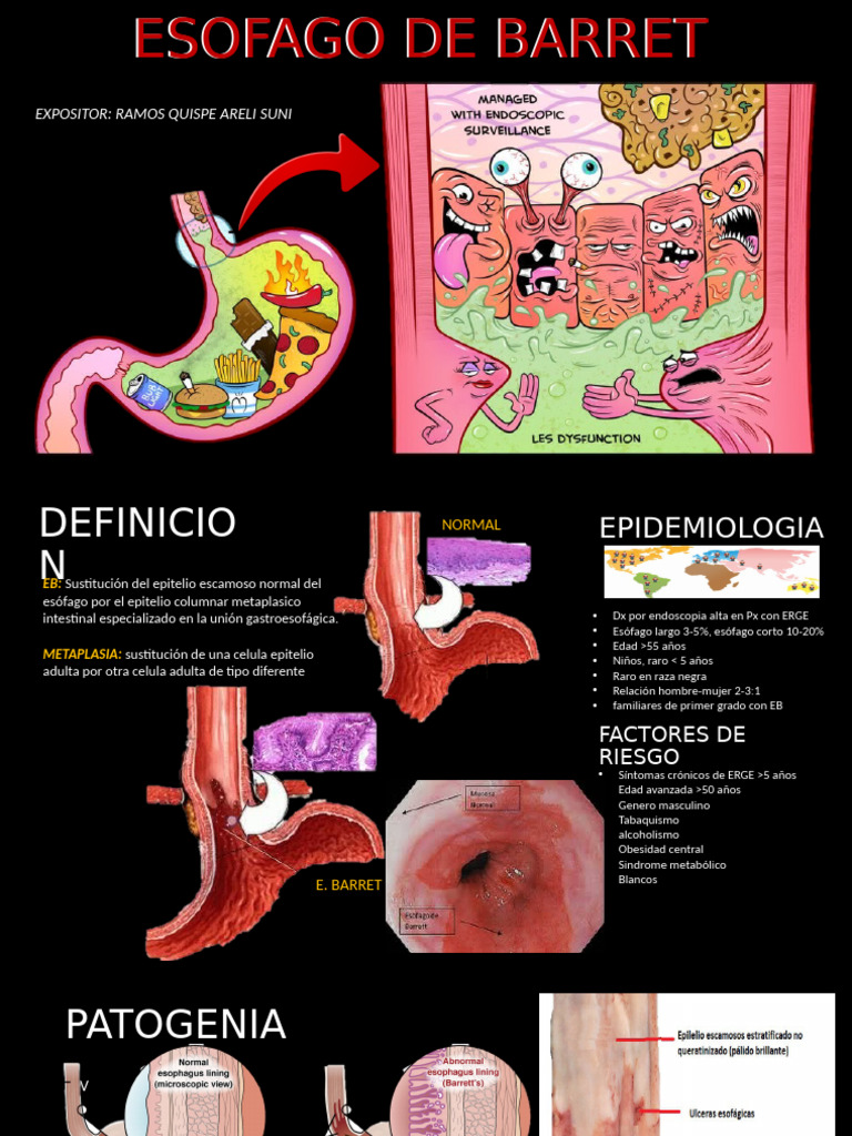Esofago de Barret | PDF | La enfermedad por reflujo gastroesofágico ...