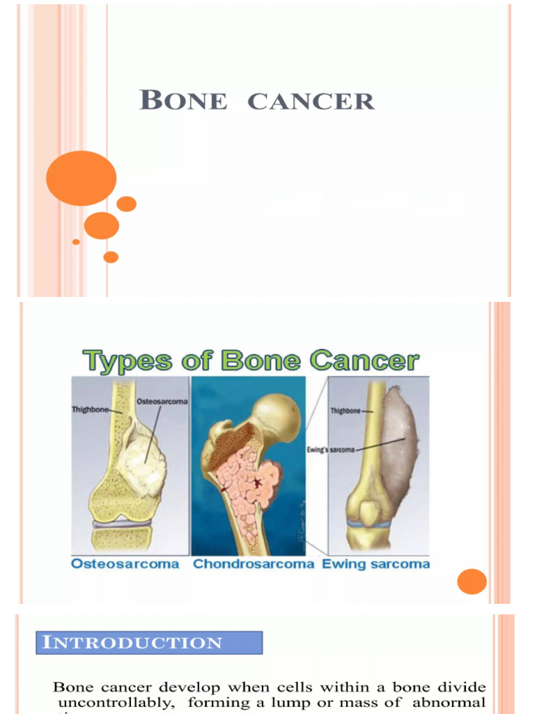 Bone Cancer | PDF