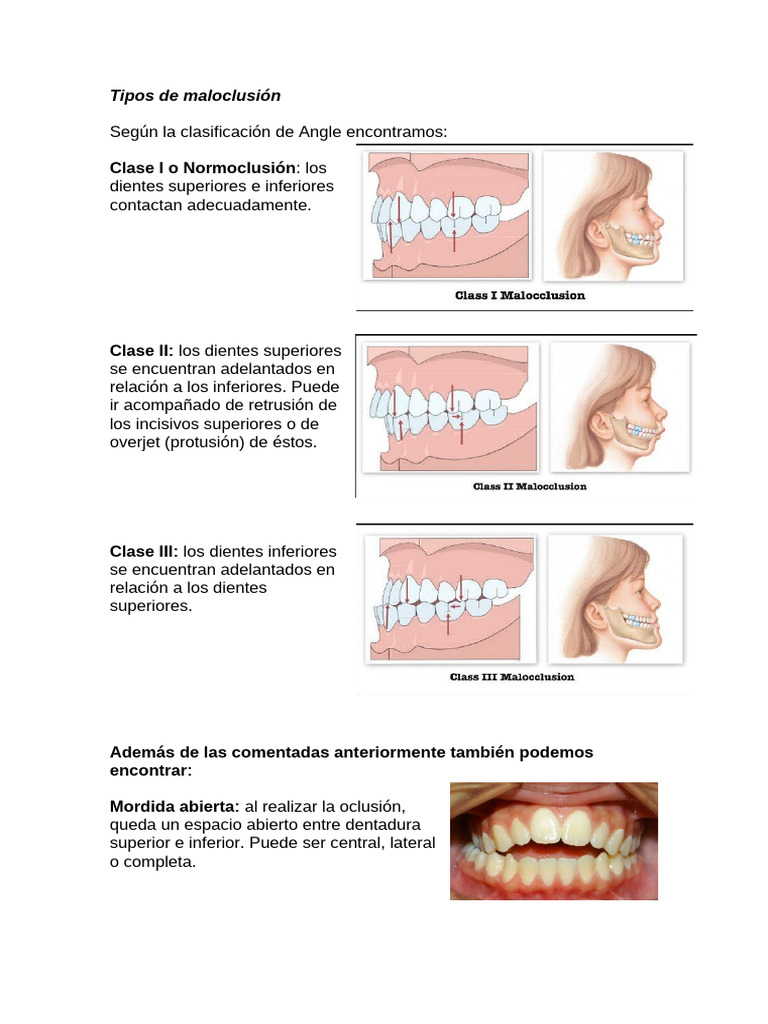 Tipos de Maloclusión | PDF