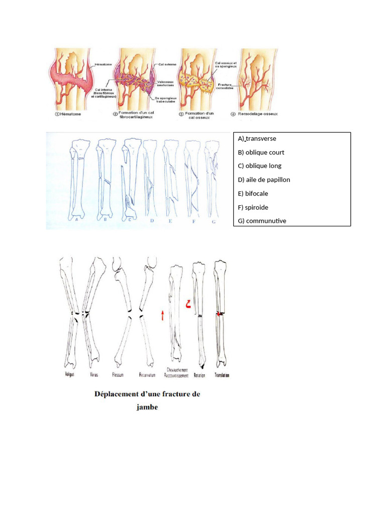 A Imprimer Fracture Jambe | PDF