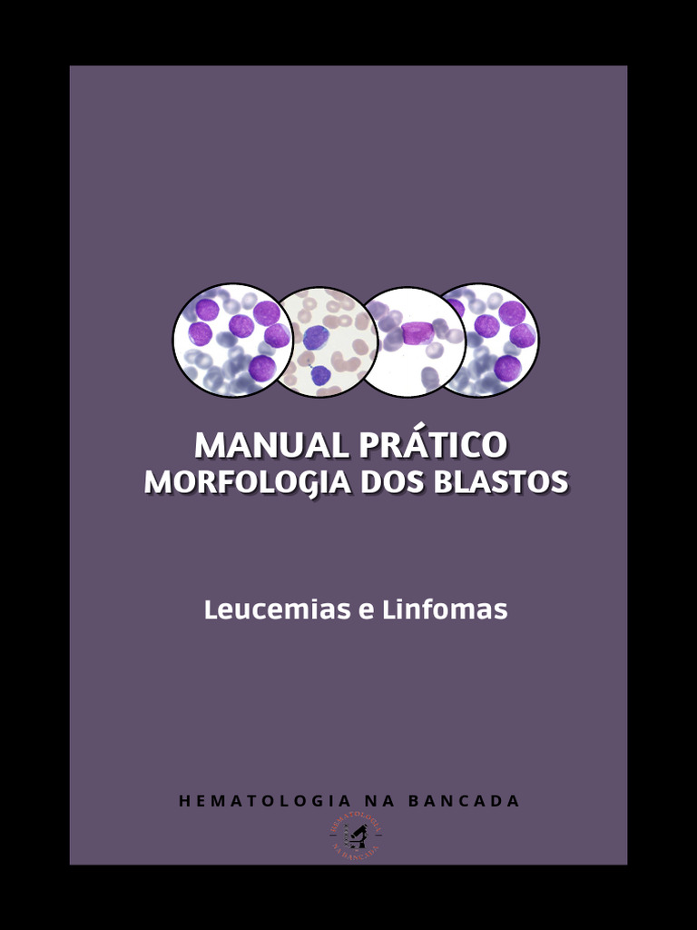 Morfologia dos Blastos em Hematologia | PDF | Leucemia | Sangue