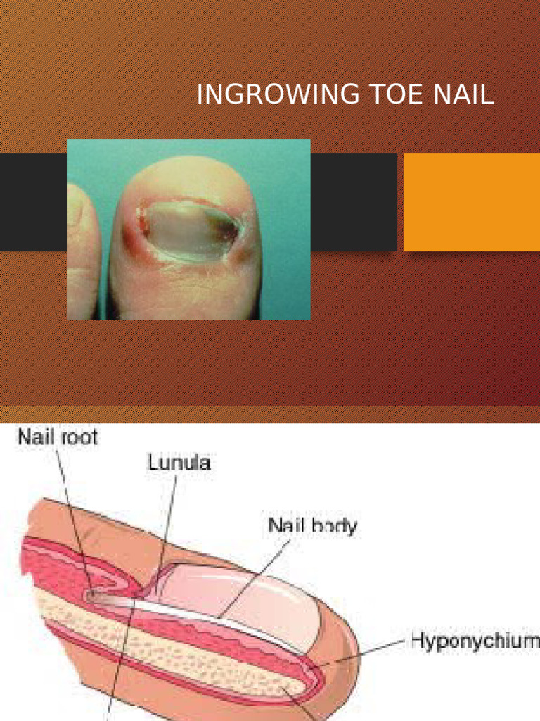 In Growing Toenail | PDF