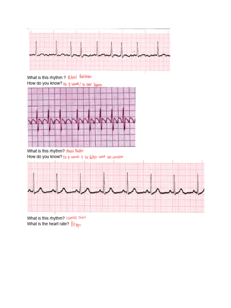 Understanding Heart Rhythm Patterns | PDF