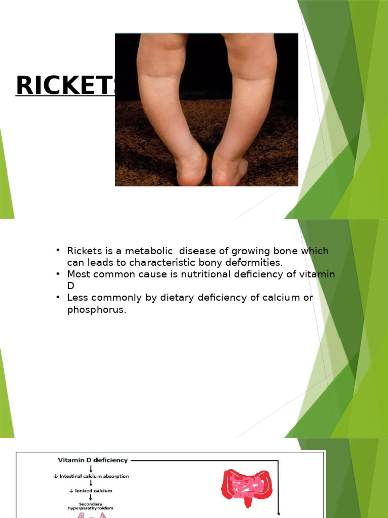 Rickets | PDF