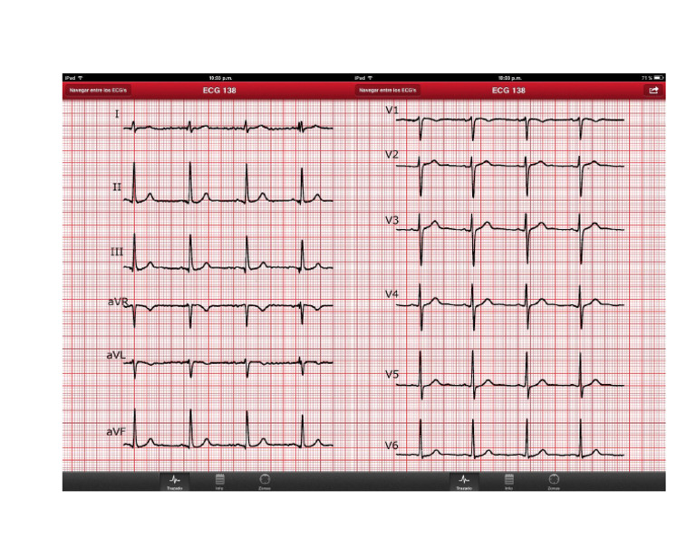 Ecg 138 | PDF