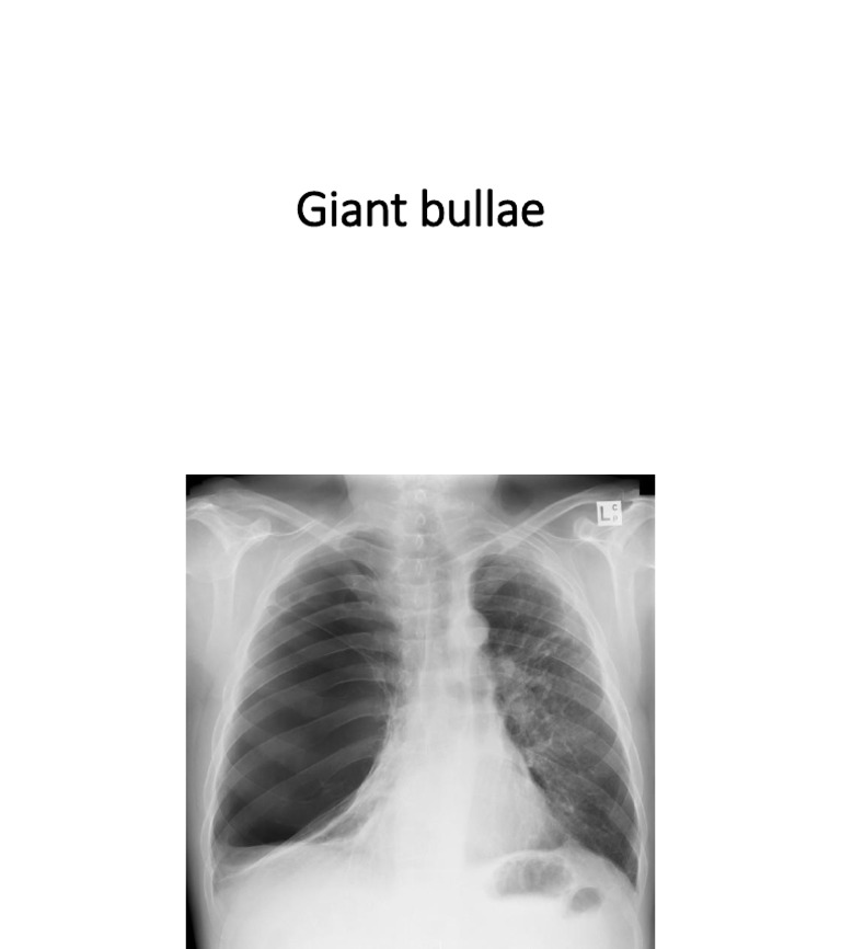 Giant Bullae | PDF