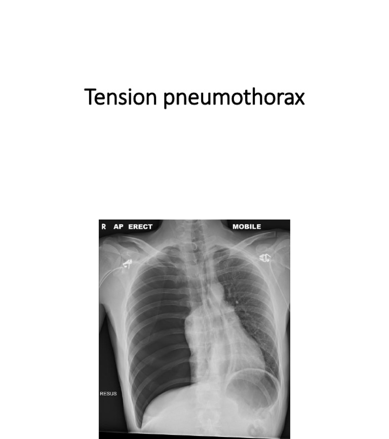 Tension Pneumothorax | PDF