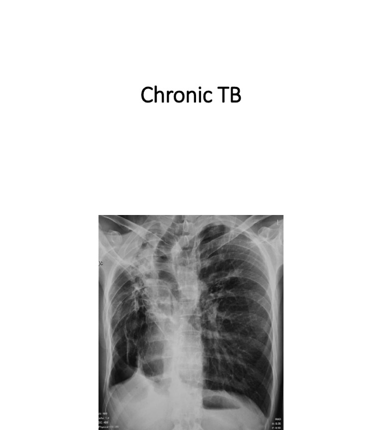 Chronic TB | PDF