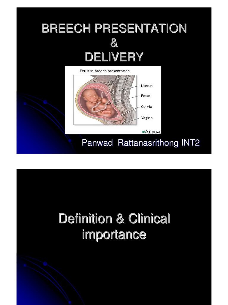 Breech Presentation and Delivery | PDF | Childbirth | Maternal Health