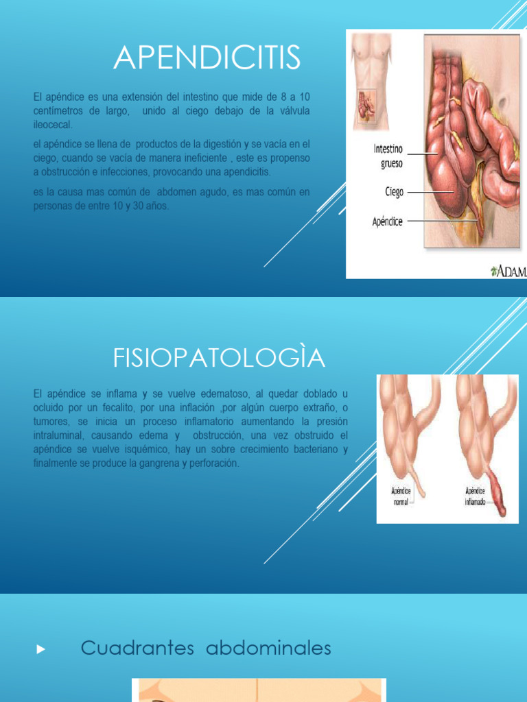 APENDICITIS Power | PDF | Medicina | Especialidades Medicas