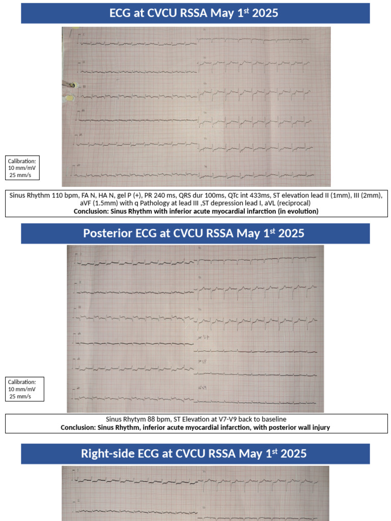 Ekg Cvcu | PDF