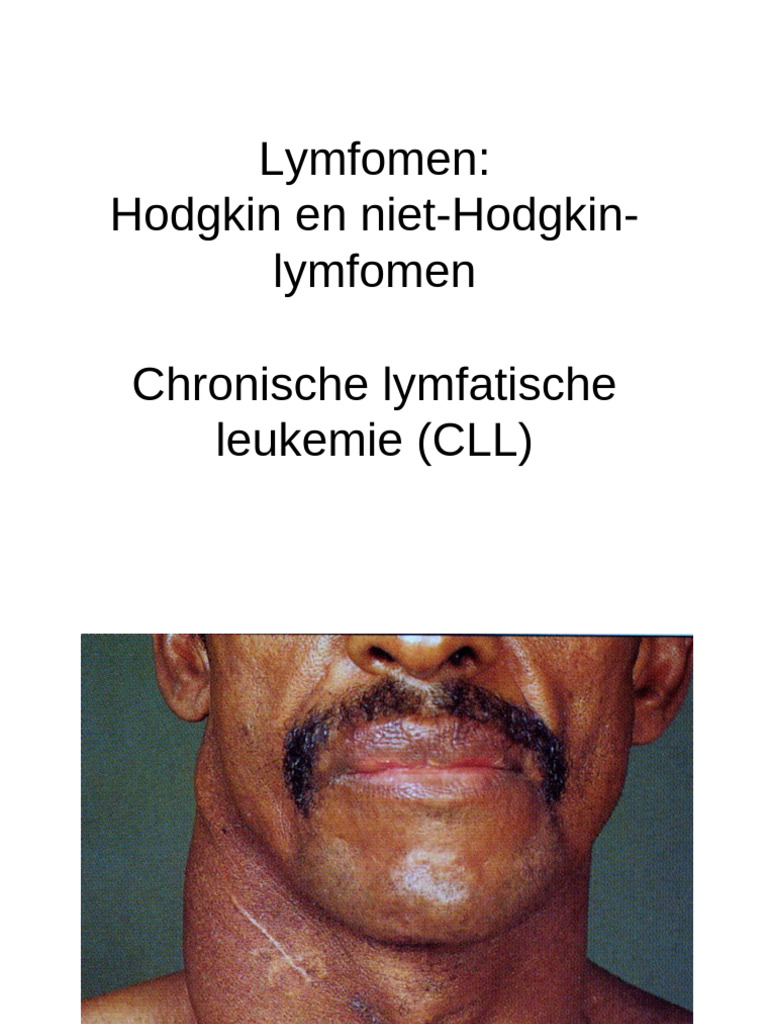 Bloed 2 - Prof. Berneman - Lymfomen en CLL - 22.12.2022 | PDF