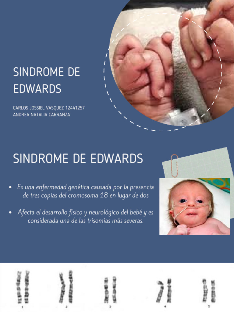 Sindrome de Edwards: Carlos Jossiel Vasquez 12441257 Andrea Natalia ...
