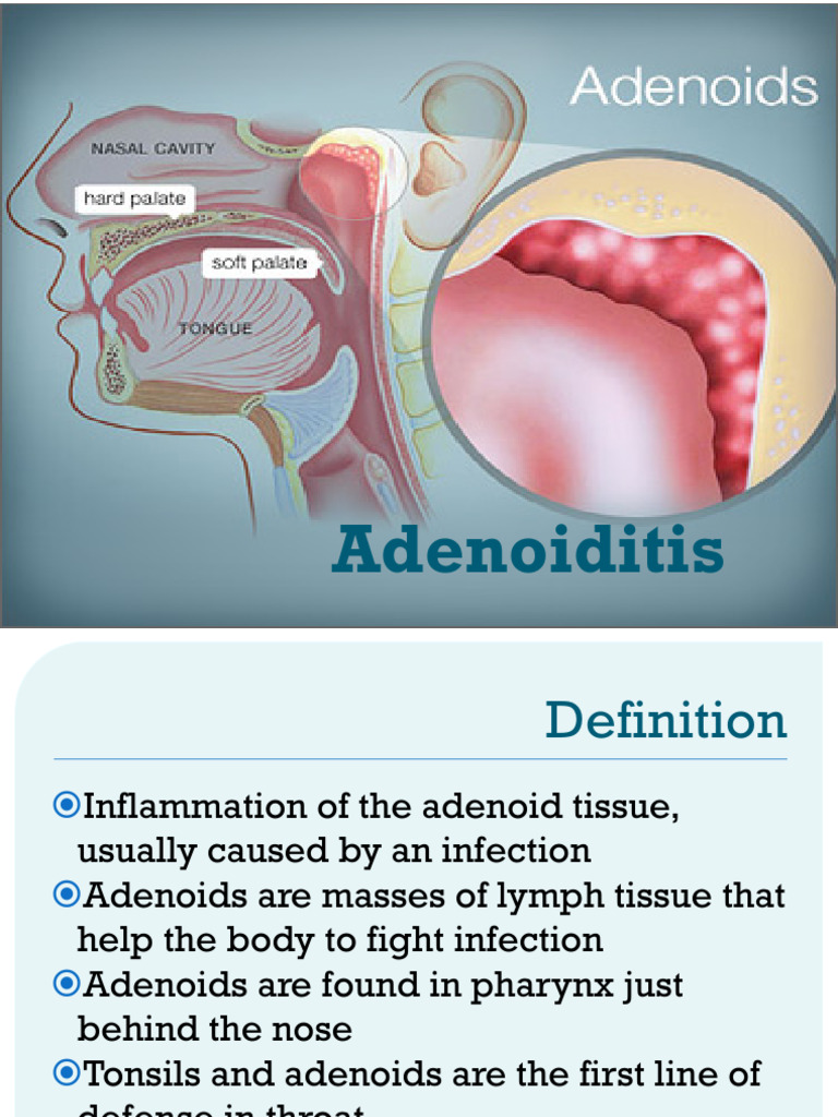 Adenoid It Is | PDF