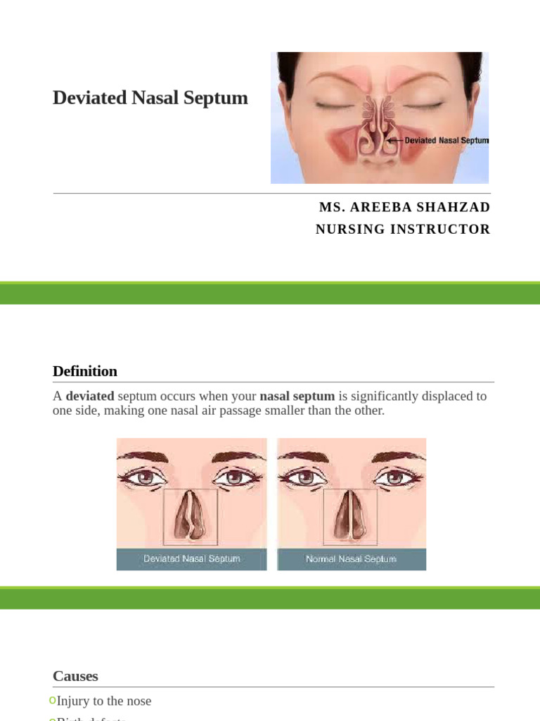 Nursing Management of Deviated Septum | PDF