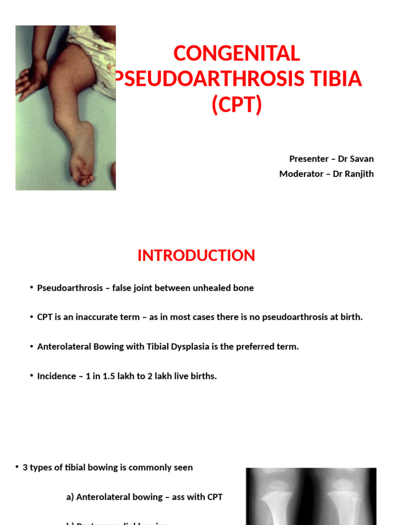 Congenital Pseudoarthrosis Tibia | PDF | Ankle | Osteoblast