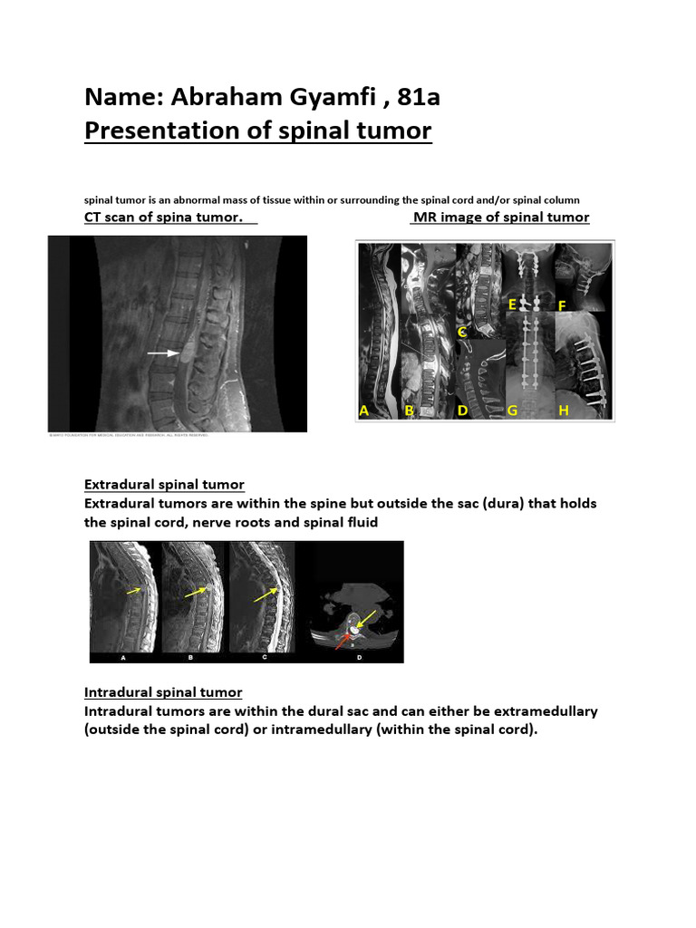 Spinal Tumor Presentation and Imaging | PDF
