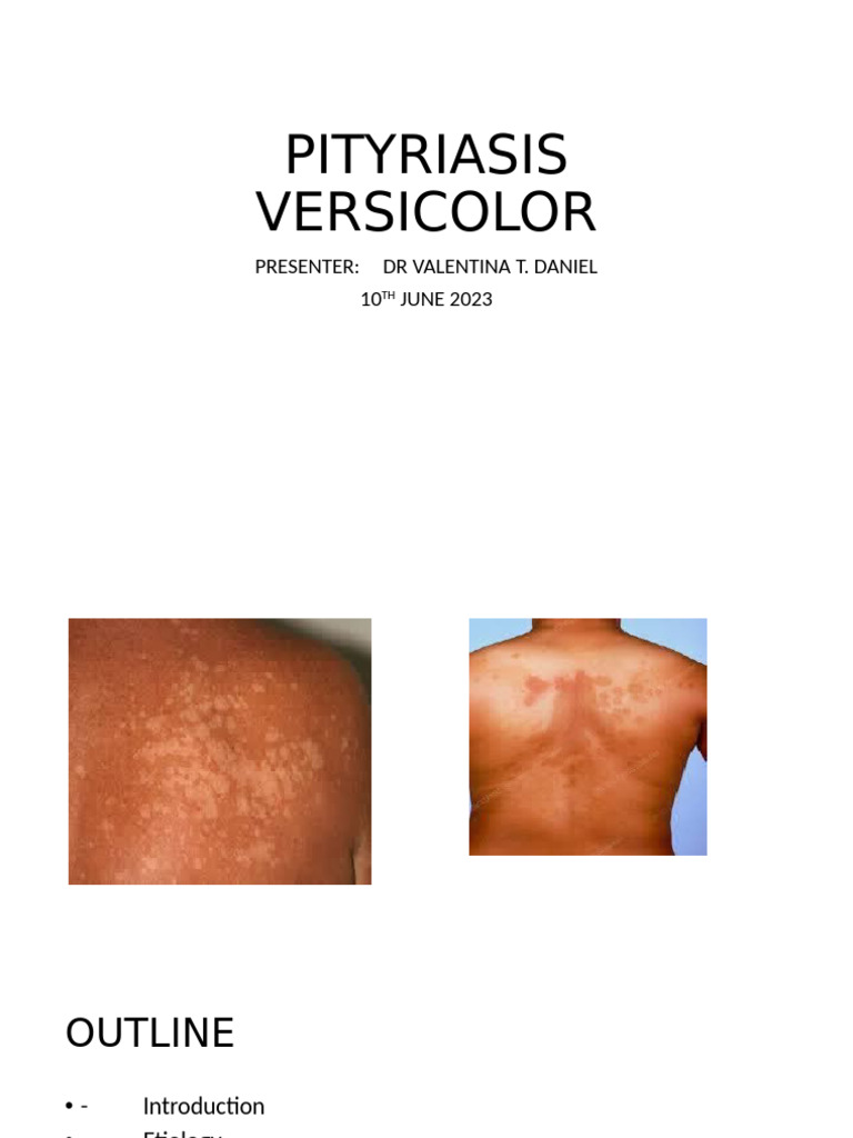 Pityriasis Versicolor Overview and Treatment | PDF | Psoriasis | Fungus