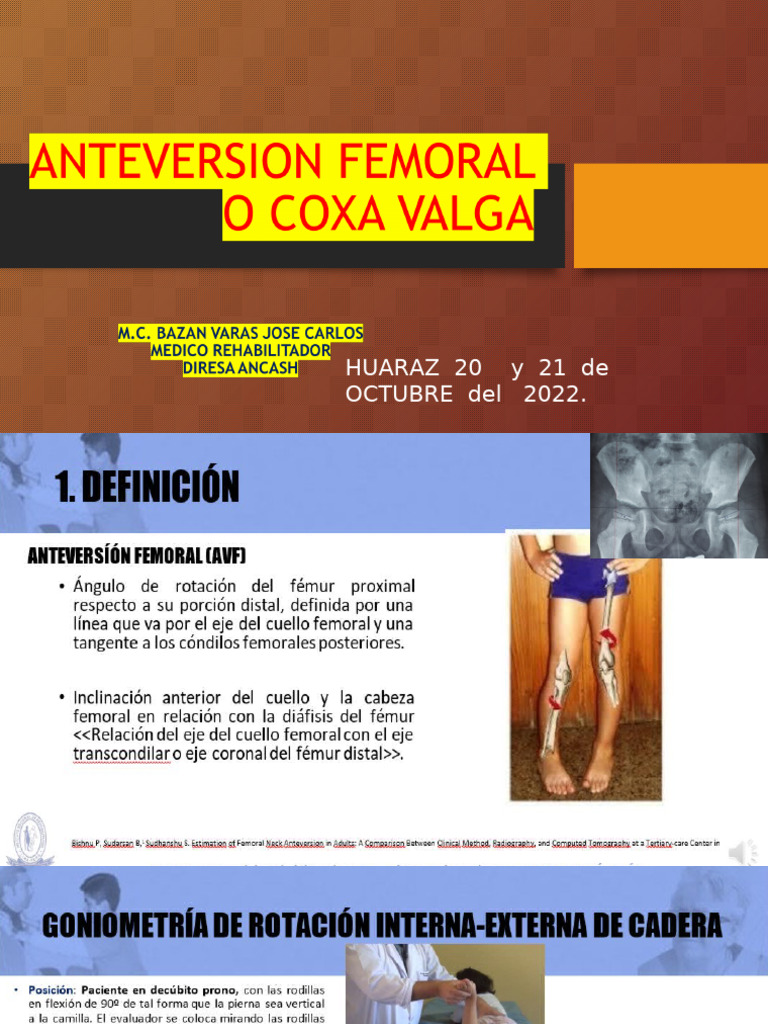 4 Anteversion Femoral | PDF
