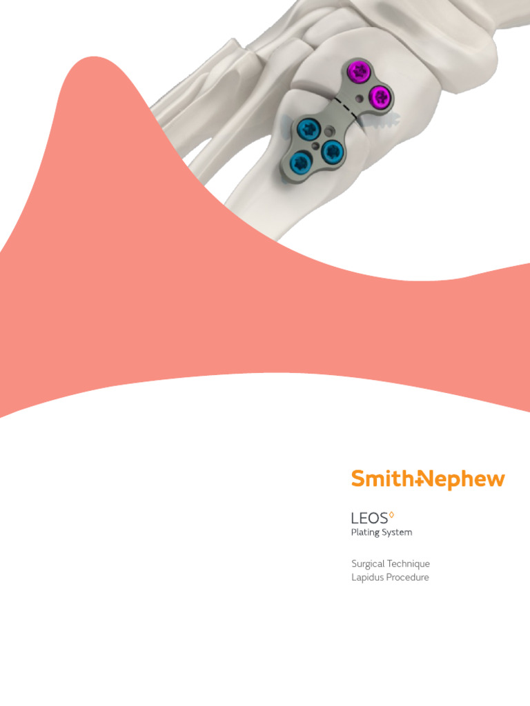 Lapidus Procedure Surgical Technique Guide | PDF | Drill | Screw