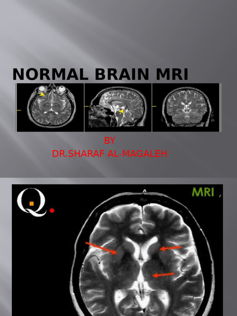 Understanding Normal Brain MRI | PDF