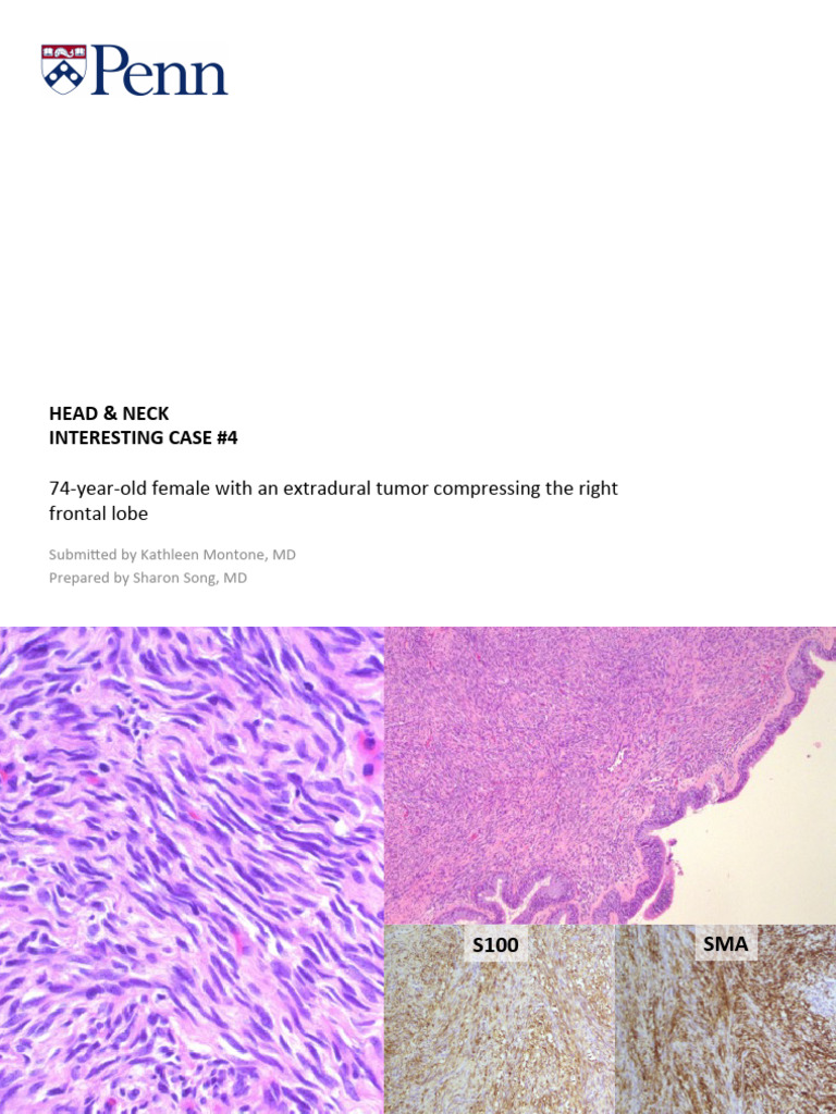 Headneck Case4 74f Extradural Tumor 0 | PDF