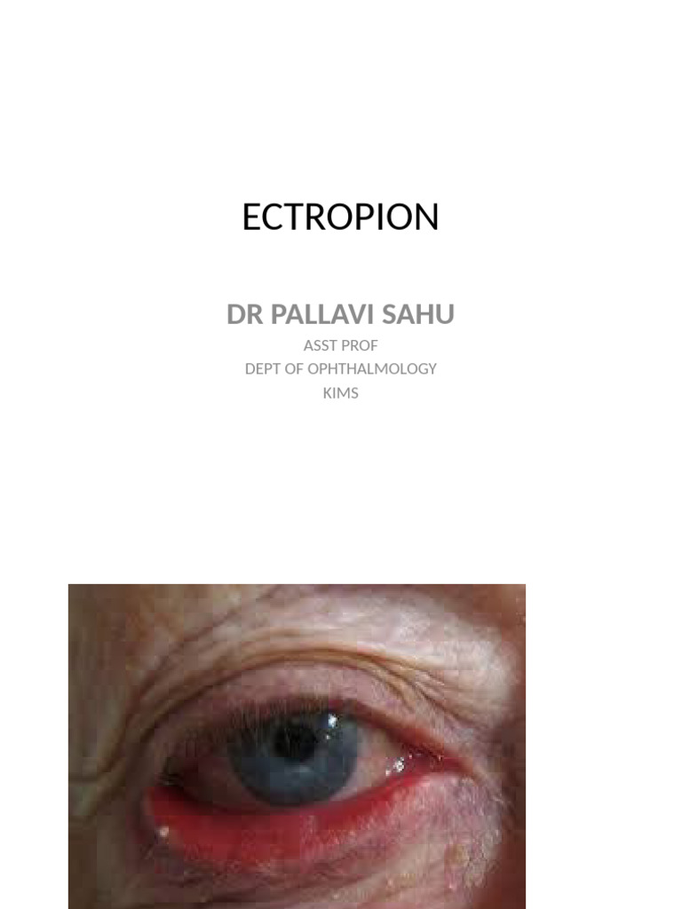ECTROPION | PDF