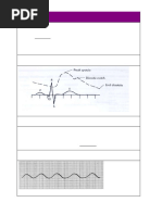Abnormal Arterial Line Waveforms - Deranged Physiology | PDF | Blood ...