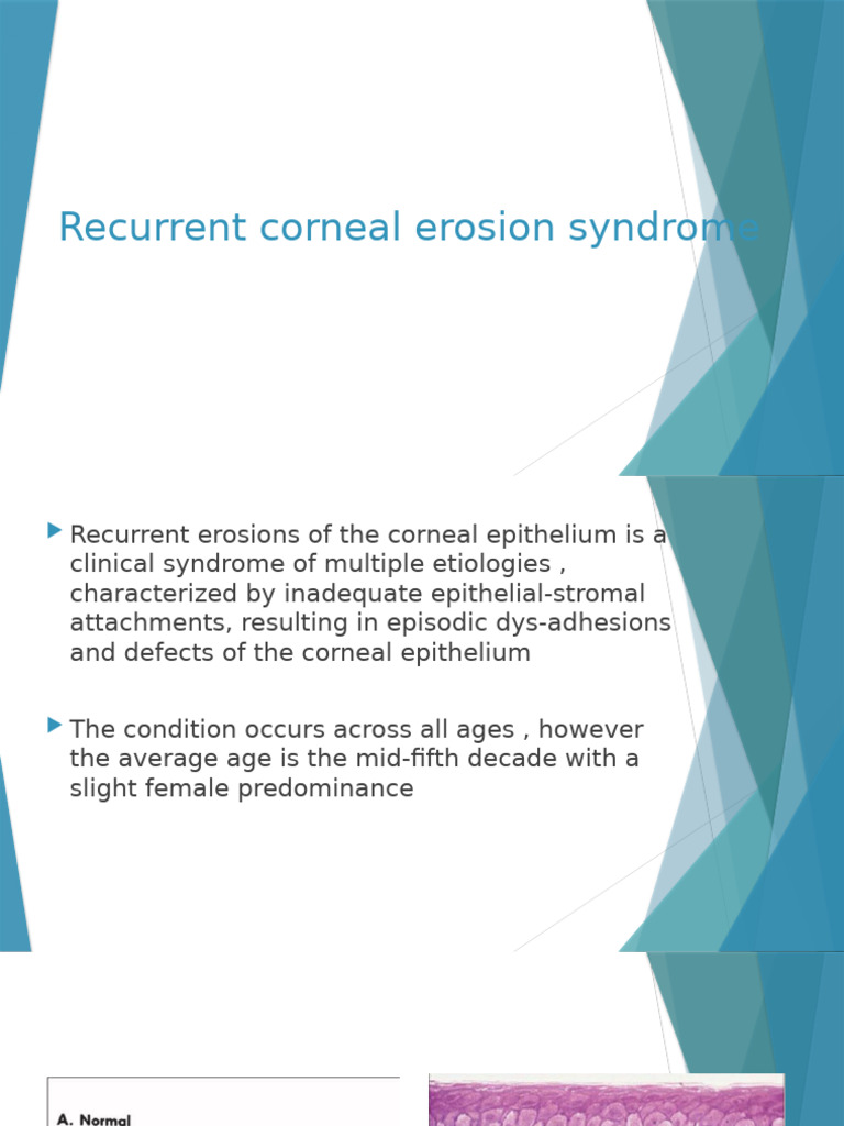 Prokera Lenses for Corneal Erosions | PDF | Cornea | Epithelium