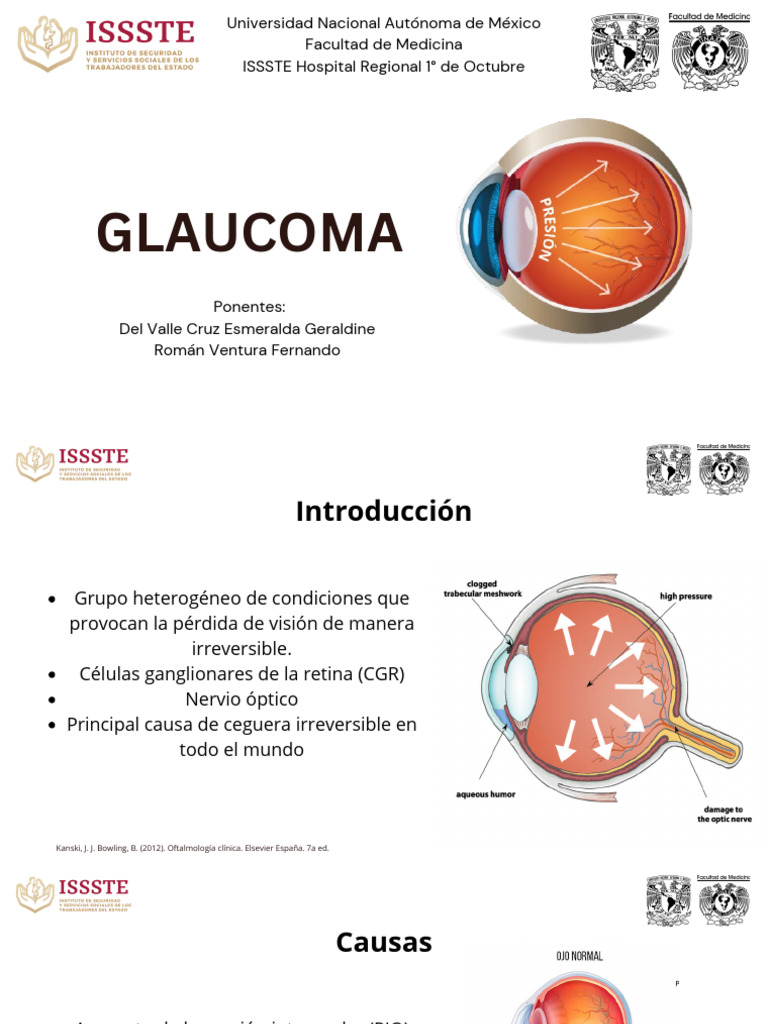 Glaucoma Oftalmo Equipo4 3728 | PDF | Glaucoma | Especialidades Medicas