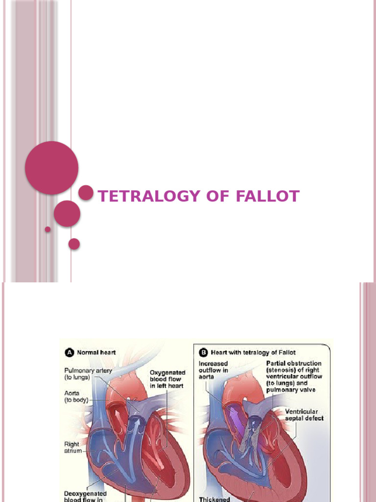 Tetralogy of Fallot | PDF