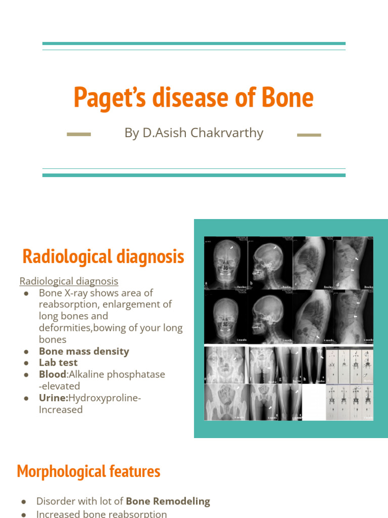 Paget's Disease of Bone | PDF