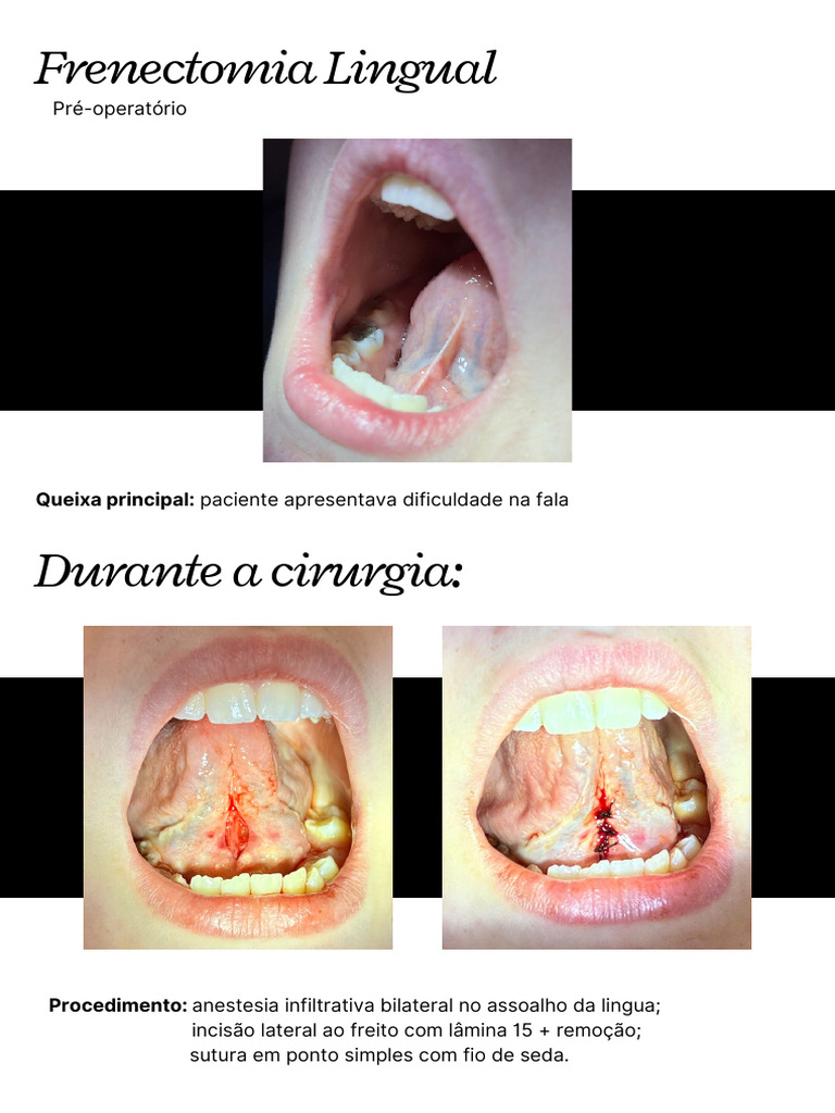 Frenectomia Labial - Andressa (1) | PDF