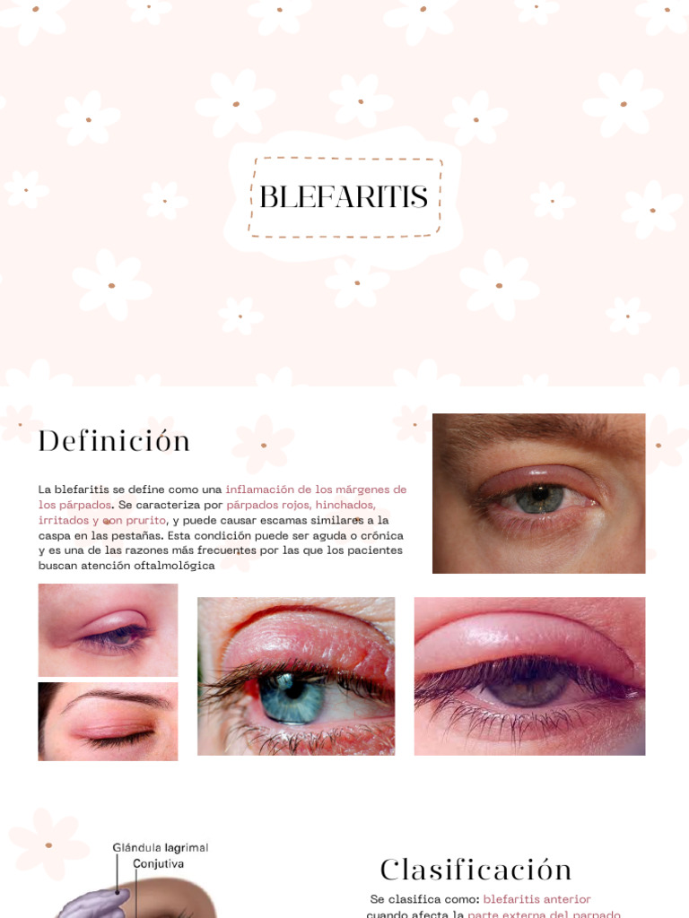 Blefaritis: Causas y Tratamientos | PDF | Medicina CLINICA | Inmunología