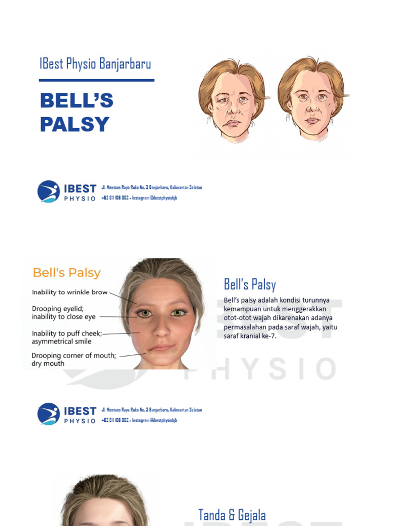 Bells Palsy | PDF