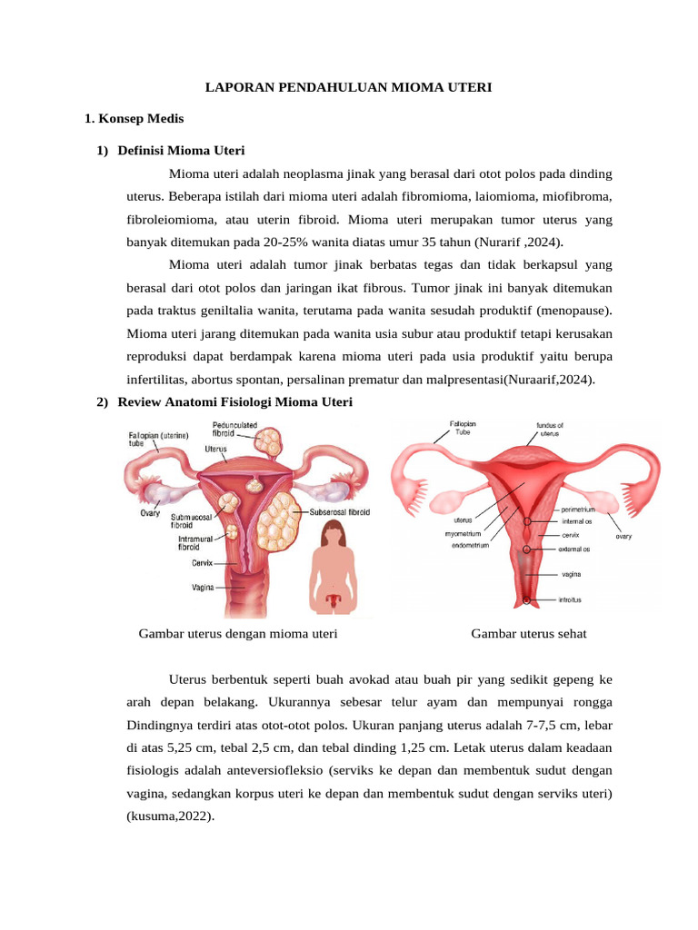 Panduan Lengkap Mioma Uteri | PDF