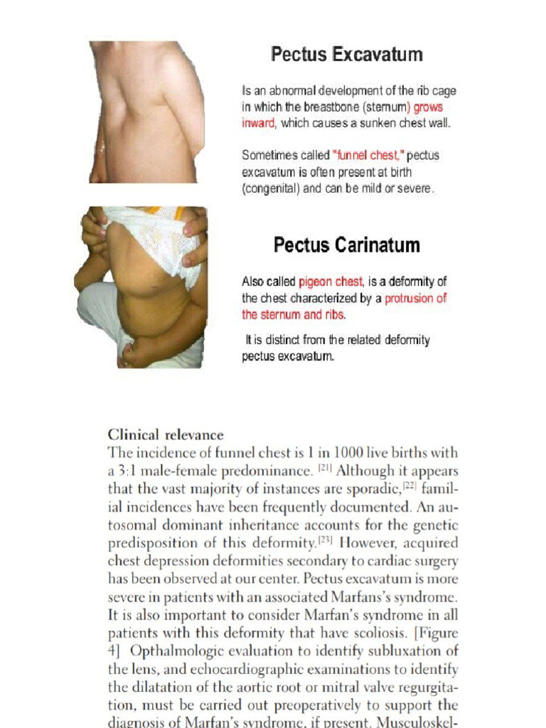 Chest Wall Deformities 1 | PDF