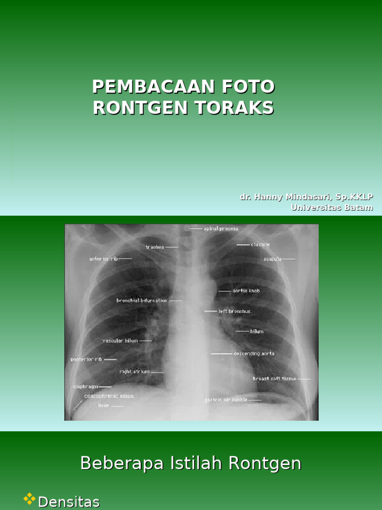 Pembacaan Rontgen Toraks dan Analisis | PDF