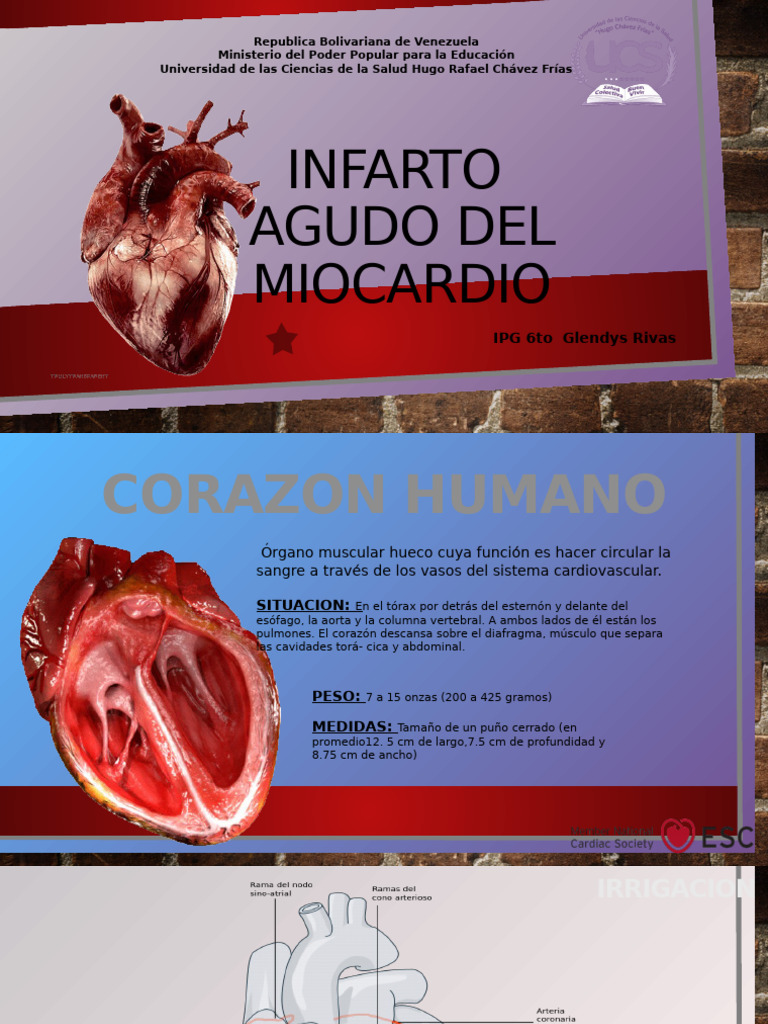 Seminario de Infarto Agudo Del Miocardio | PDF | Infarto de miocardio ...