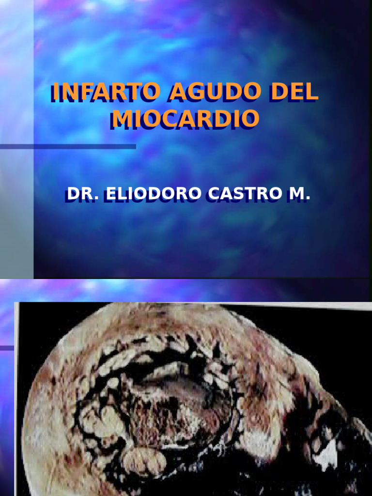 Infarto Agudo del Miocardio: Causas y Tratamiento | PDF | Infarto de ...